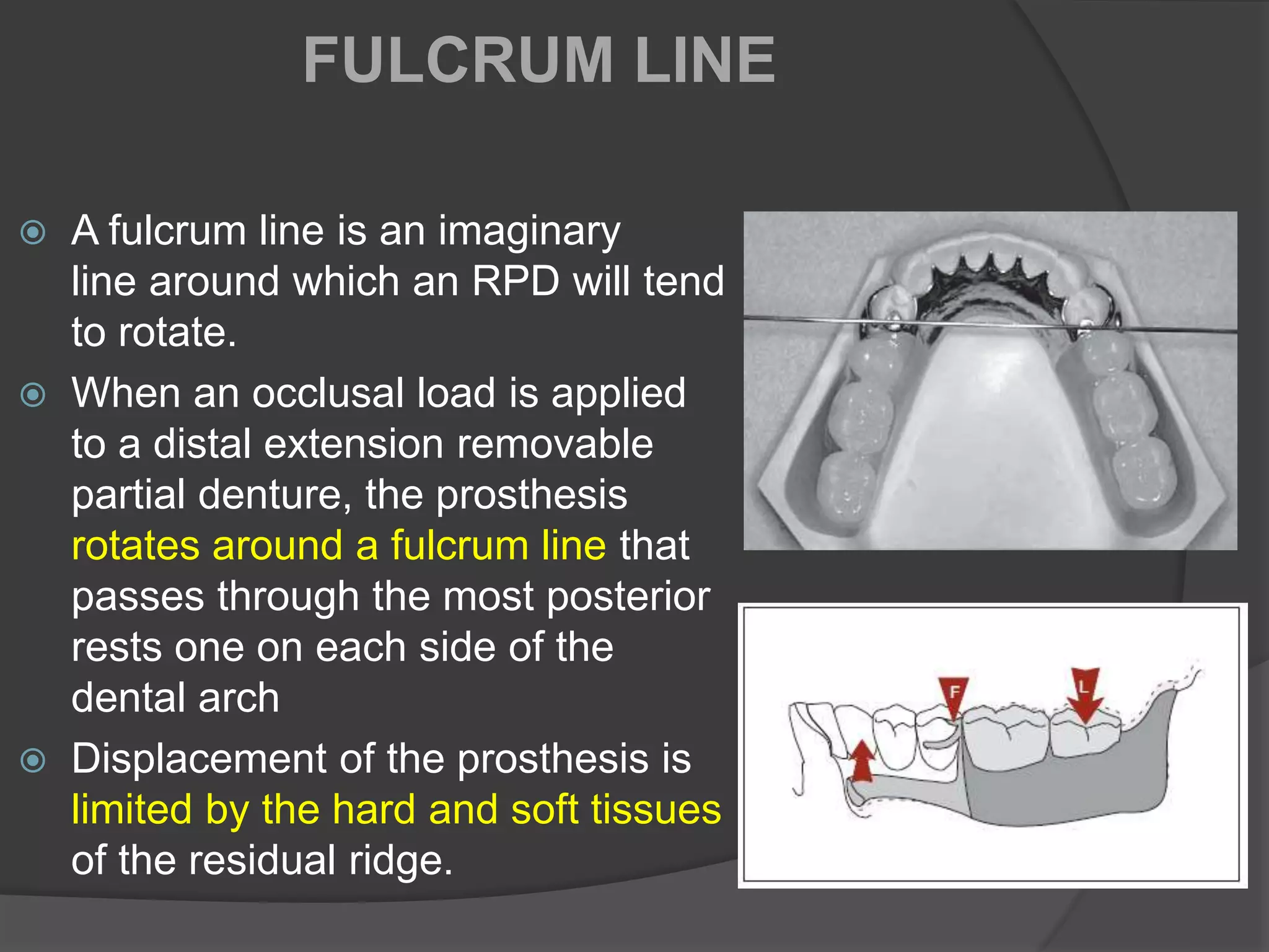 INDIRECT RETAINERS IN REMOVABLE PARTIAL DENTURES | PPTX