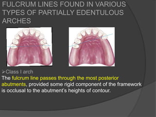 INDIRECT RETAINERS IN REMOVABLE PARTIAL DENTURES | PPTX