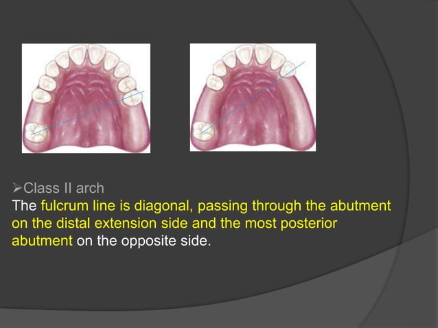 INDIRECT RETAINERS IN REMOVABLE PARTIAL DENTURES | PPTX | Dental Health ...