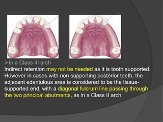 INDIRECT RETAINERS IN REMOVABLE PARTIAL DENTURES | PPTX