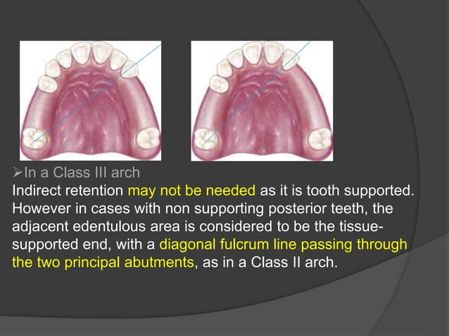 INDIRECT RETAINERS IN REMOVABLE PARTIAL DENTURES | PPTX | Dental Health ...