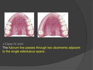 INDIRECT RETAINERS IN REMOVABLE PARTIAL DENTURES | PPTX