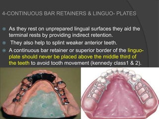 INDIRECT RETAINERS IN REMOVABLE PARTIAL DENTURES | PPTX