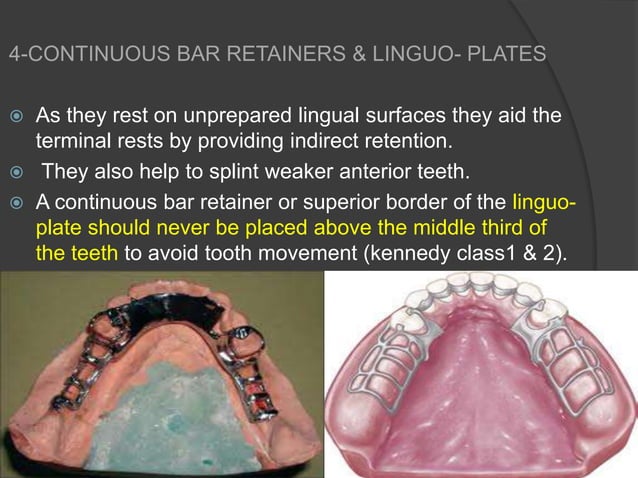 INDIRECT RETAINERS IN REMOVABLE PARTIAL DENTURES | PPTX | Dental Health ...