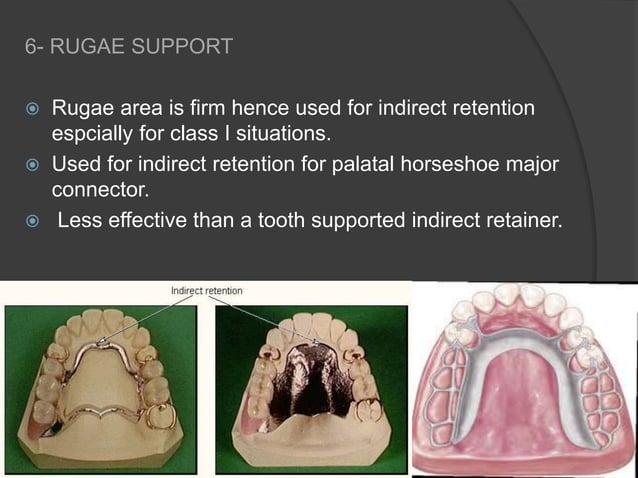 INDIRECT RETAINERS IN REMOVABLE PARTIAL DENTURES | PPTX | Dental Health ...