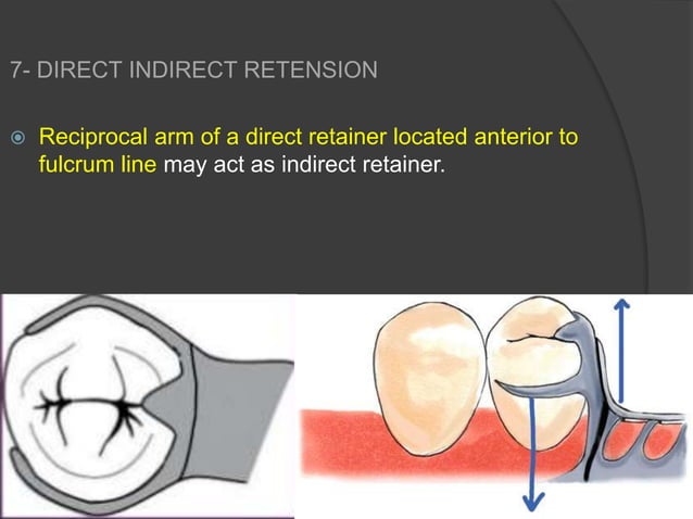 INDIRECT RETAINERS IN REMOVABLE PARTIAL DENTURES | PPTX | Dental Health ...
