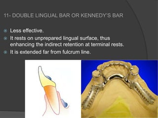 INDIRECT RETAINERS IN REMOVABLE PARTIAL DENTURES | PPTX