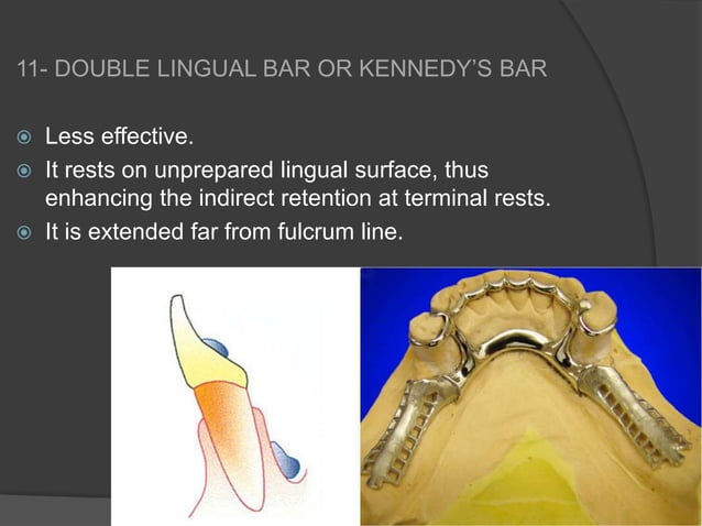 INDIRECT RETAINERS IN REMOVABLE PARTIAL DENTURES | PPTX | Dental Health ...
