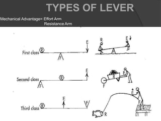 INDIRECT RETAINERS IN REMOVABLE PARTIAL DENTURES | PPTX