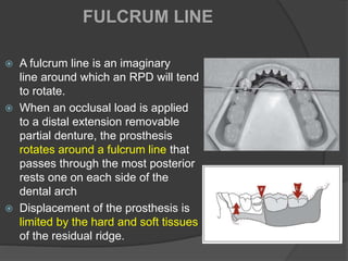 INDIRECT RETAINERS IN REMOVABLE PARTIAL DENTURES | PPTX
