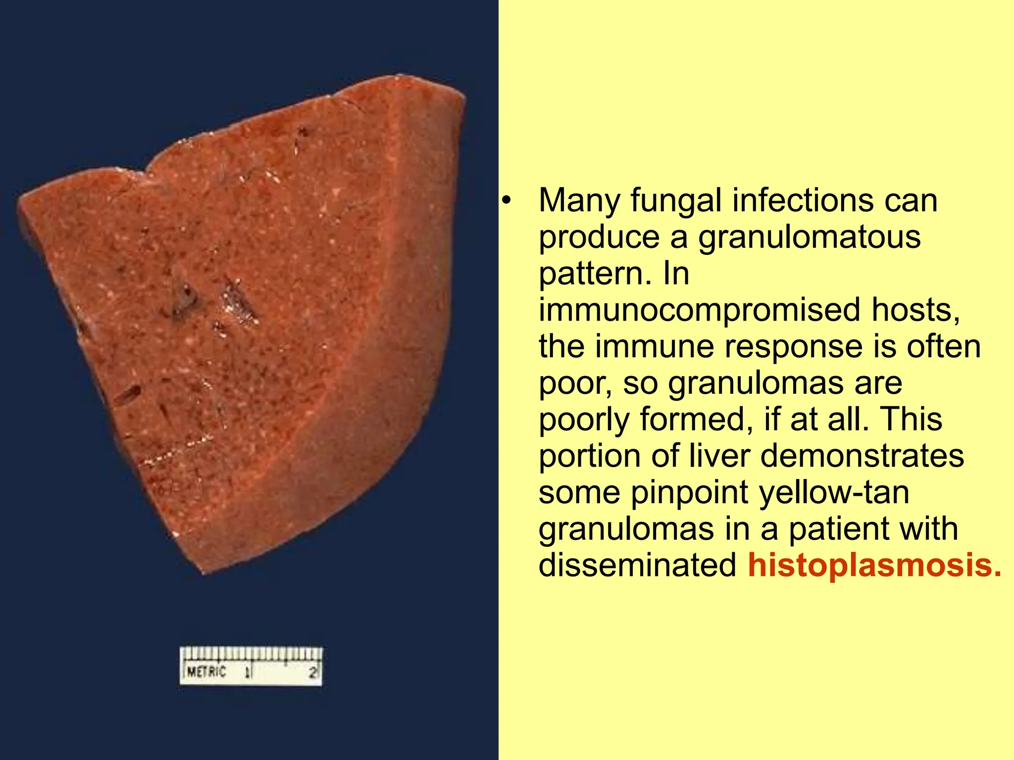 6-INFECTIONS pathology power point presentation | PPT