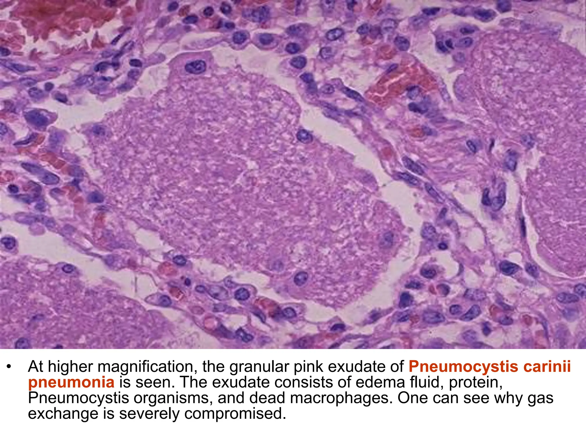 6-INFECTIONS pathology power point presentation | PPT