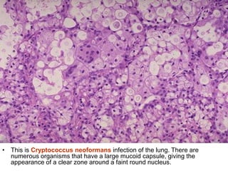 6-INFECTIONS pathology power point presentation | PPT