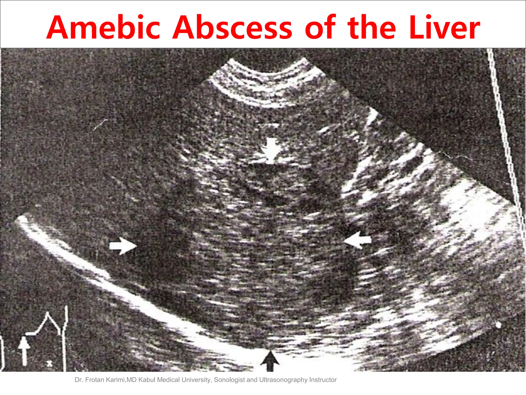 ultrasound of Liver and sublement part two .pdf