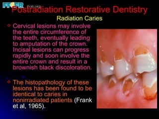Radiation Caries