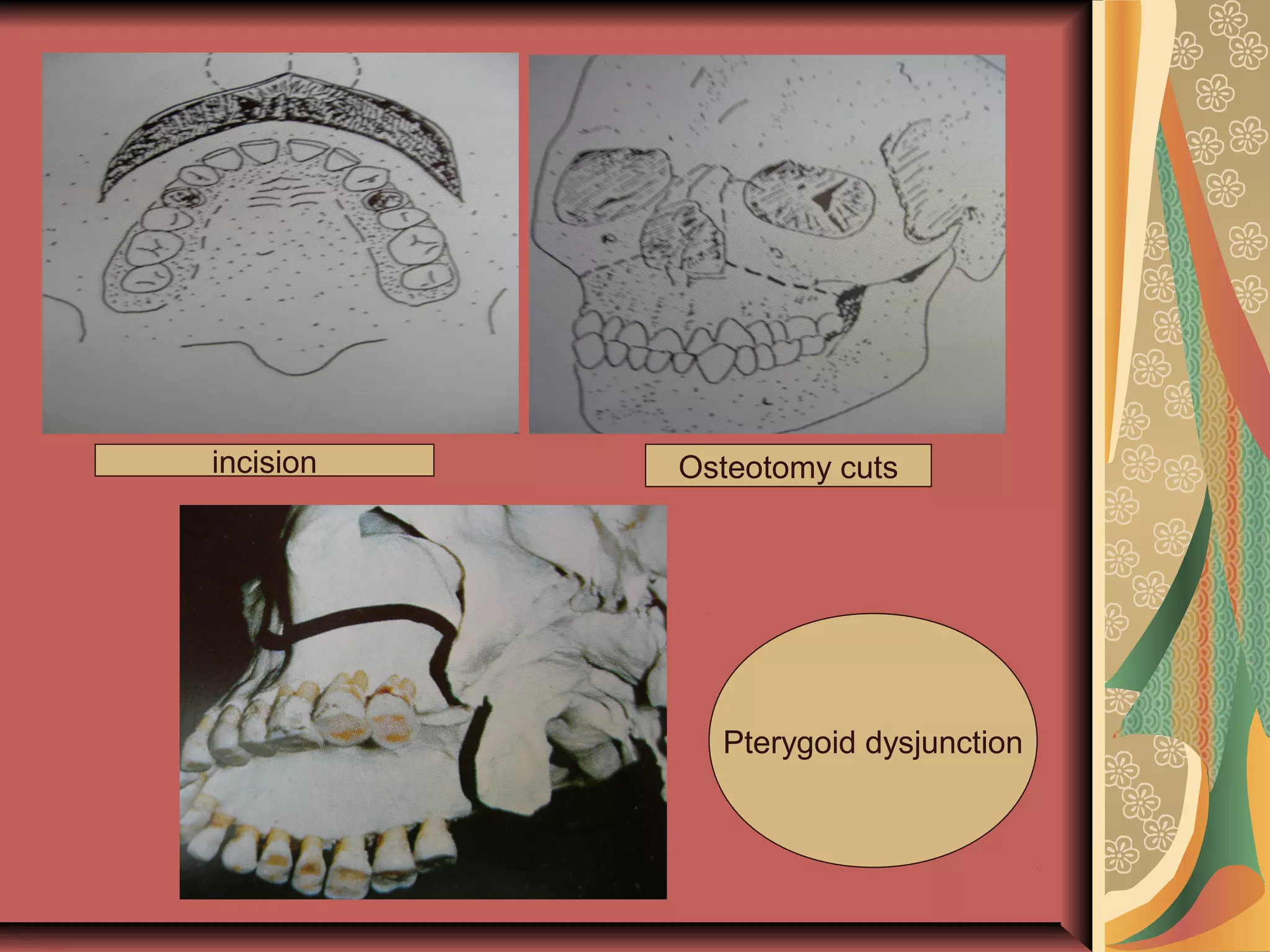 6 maxillary osteotomies | PPT