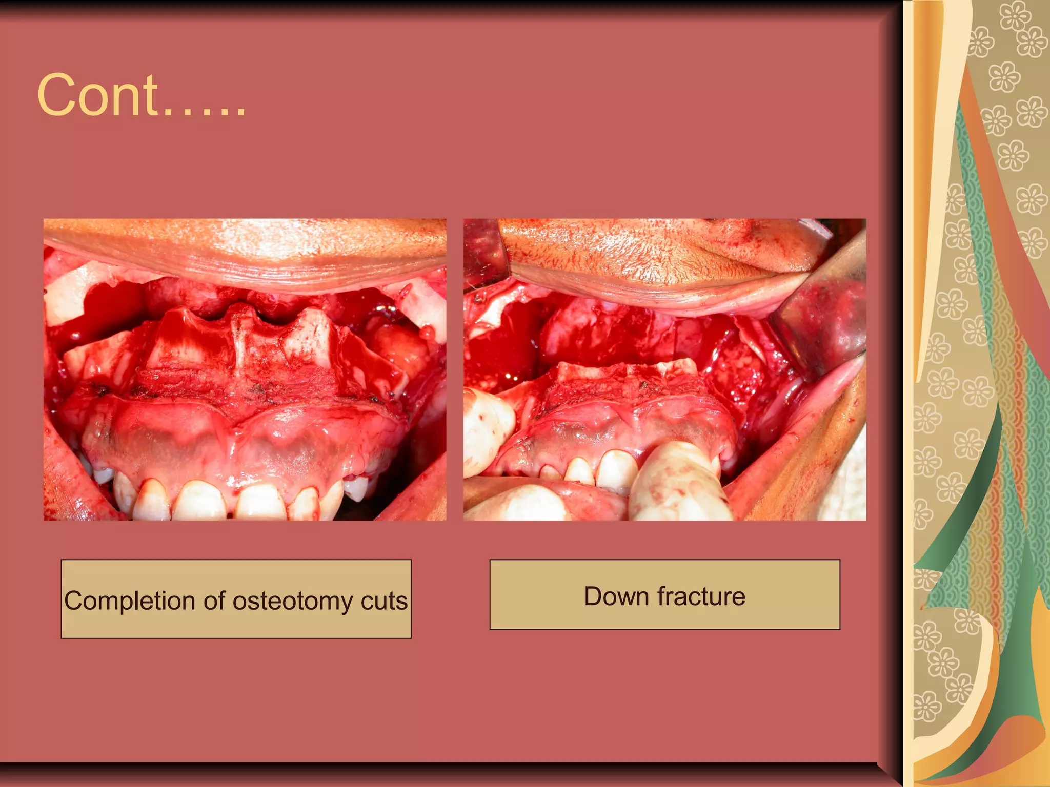 6 maxillary osteotomies | PPT