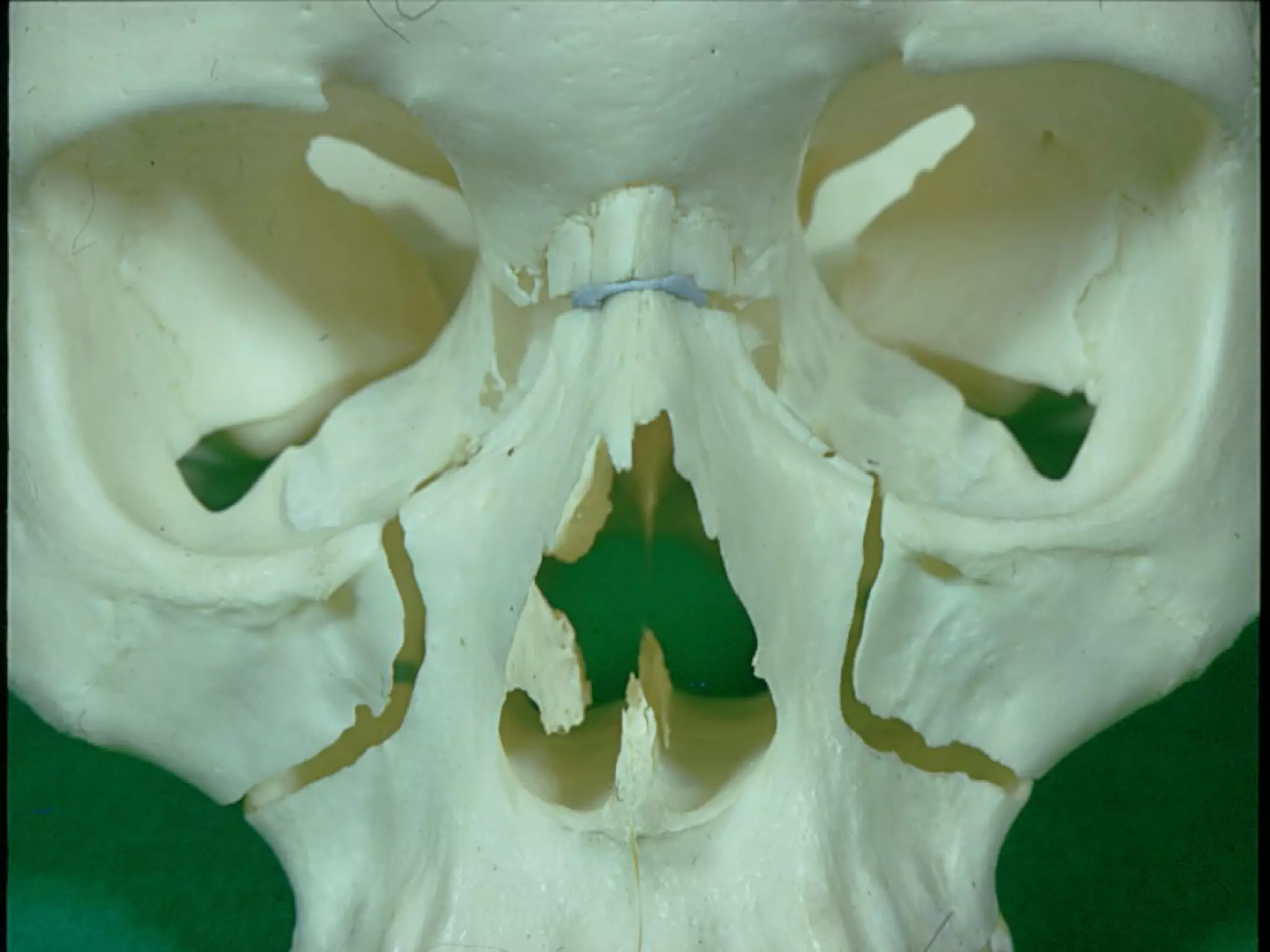 6 maxillary osteotomies | PPT | Dental Health | Diseases and Conditions