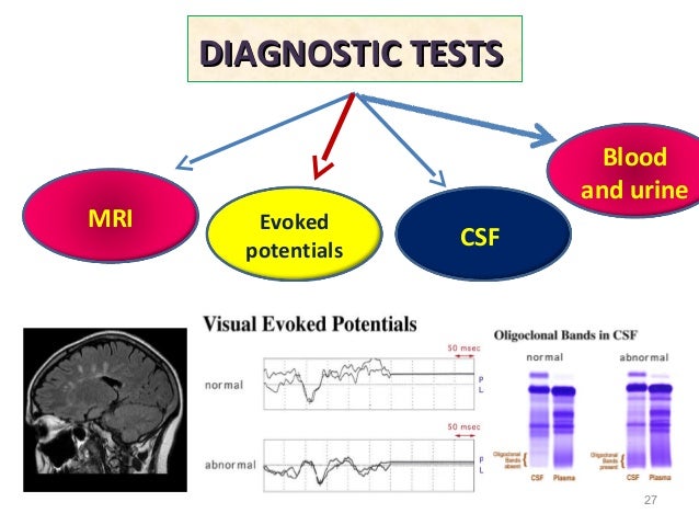 6 multiple sclerosis nero medicine