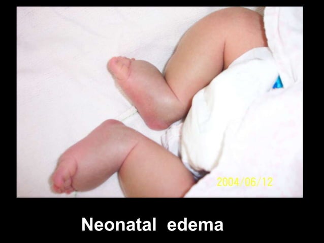 Neonatal Cold Injury Syndrome | PPT | Blood Disorders | Diseases and ...