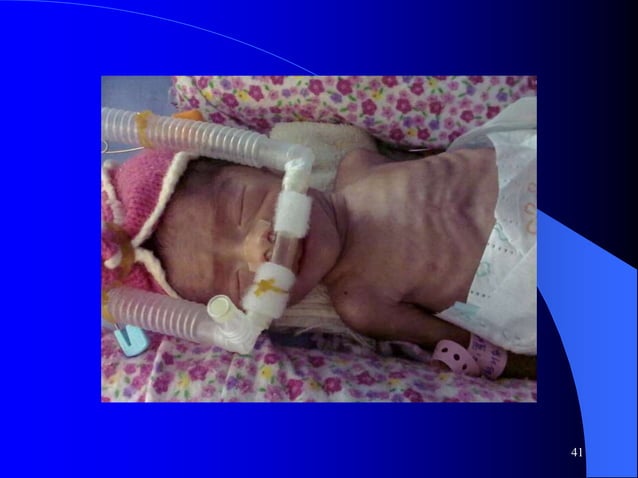 6--NEONATOLOGY NRDS{6}.ppt