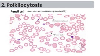 6 - Normal and Abnormal Red Blood Cells Morphology .pdf
