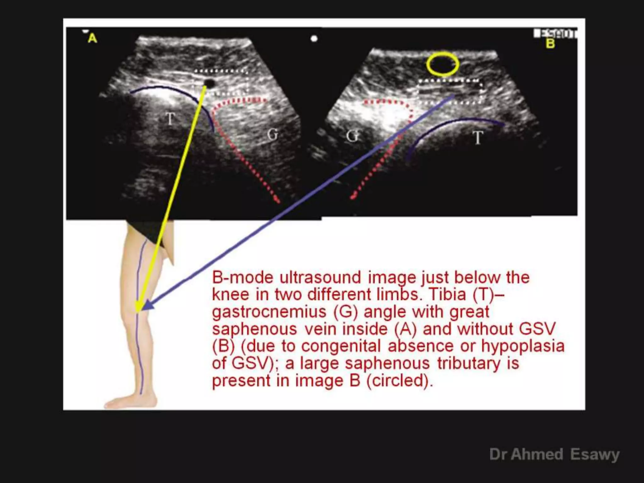 6 peripheral venous duplex superfiscial venous system in lower limb ...