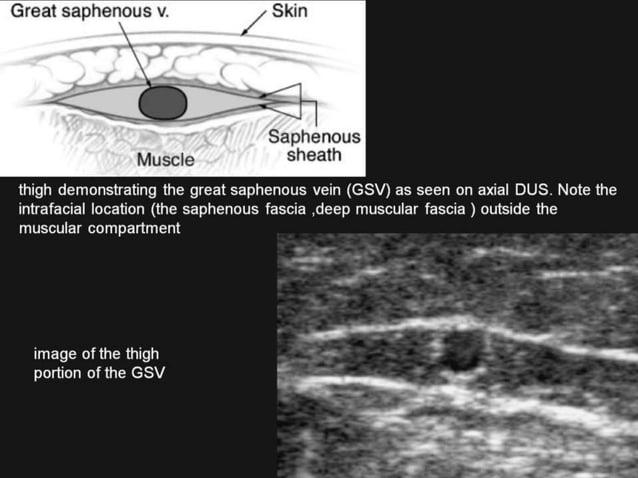 6 peripheral venous duplex superfiscial venous system in lower limb ...