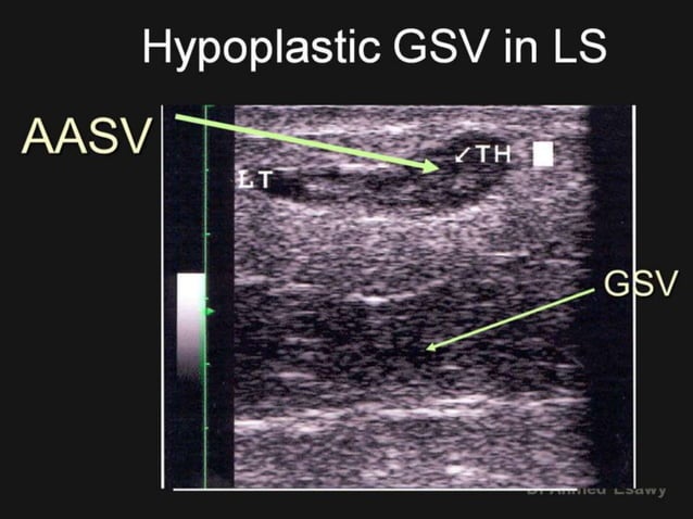 6 peripheral venous duplex superfiscial venous system in lower limb ...