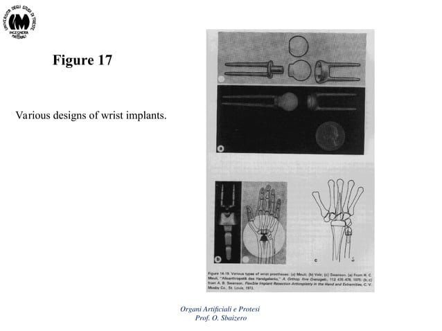 Protesi articolari de cadera biomecanica | PPT