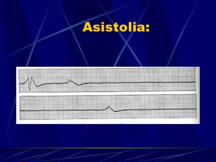 ReanimacióN Cardiopulmonar