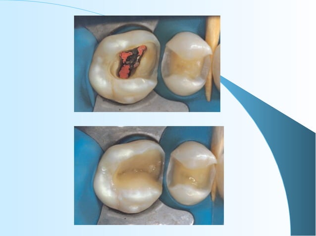 6.restoration of the endodontically treated tooth | PPT