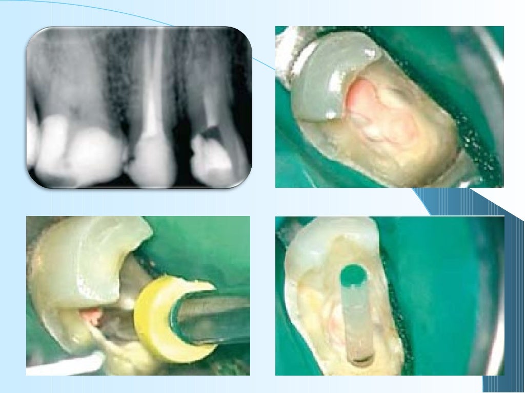 6.restoration of the endodontically treated tooth