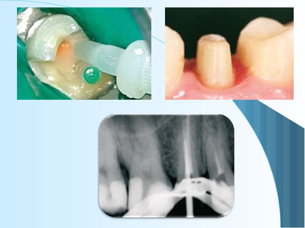 6.restoration of the endodontically treated tooth