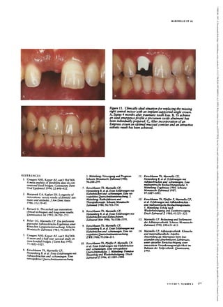 6 - Single-tooth replacement Some clinical aspects.pdf