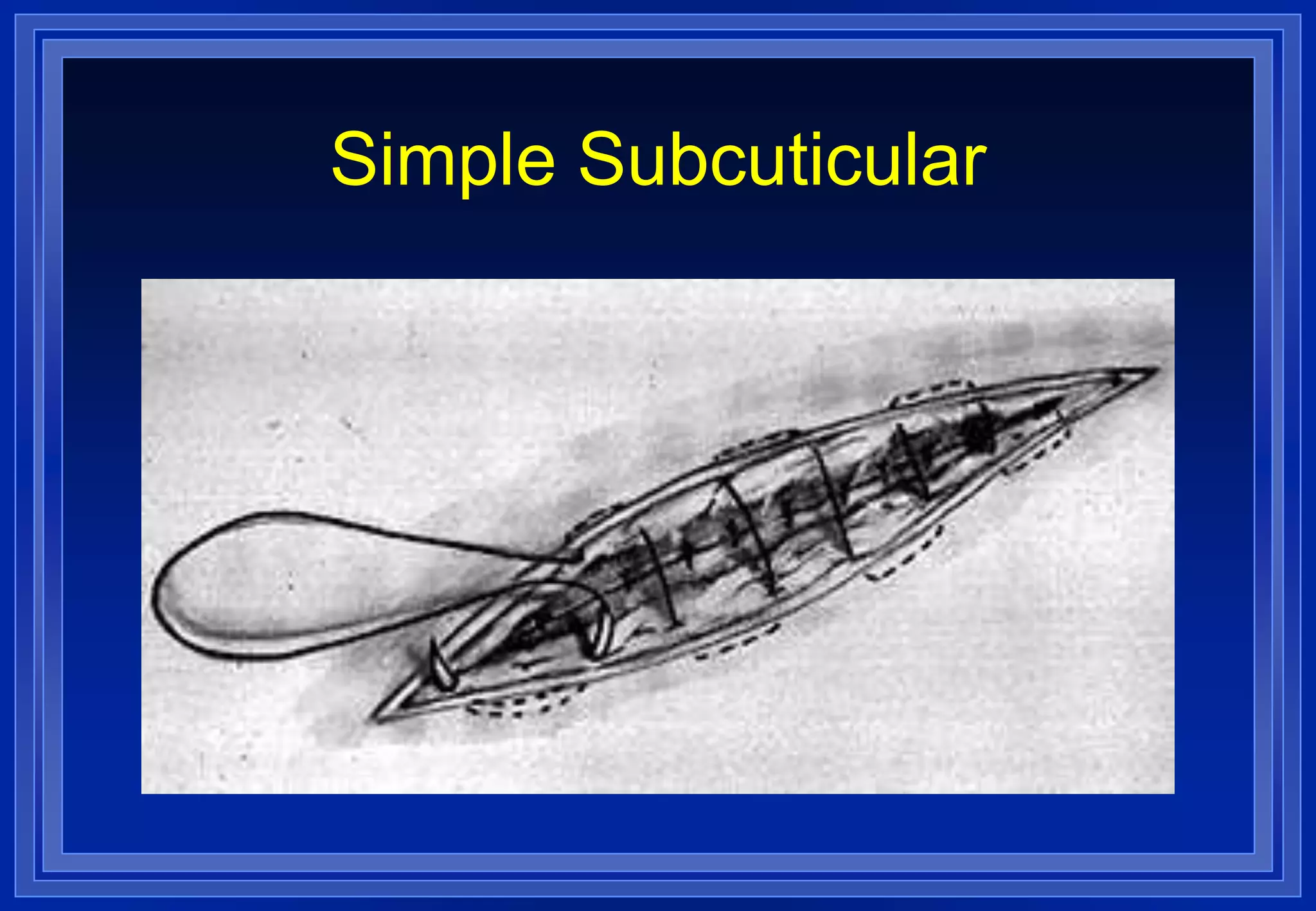 SUTURE PATTERNS.ppt