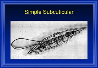 SUTURE PATTERNS.ppt