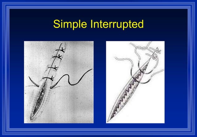 SUTURE PATTERNS.ppt