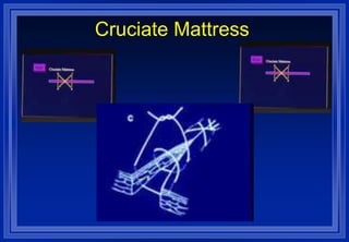 SUTURE PATTERNS.ppt
