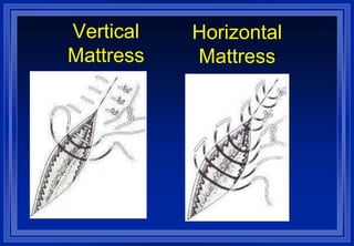 SUTURE PATTERNS.ppt