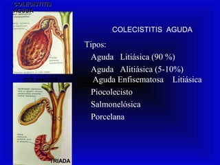 6. taller de colecistectomía | PPT