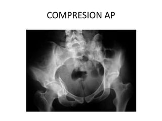 6 Trauma de Pelvis, Dr Camilo Estrada | PPTX
