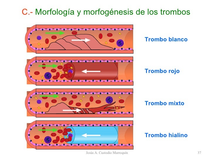 Trombosis