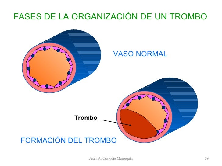 Trombosis