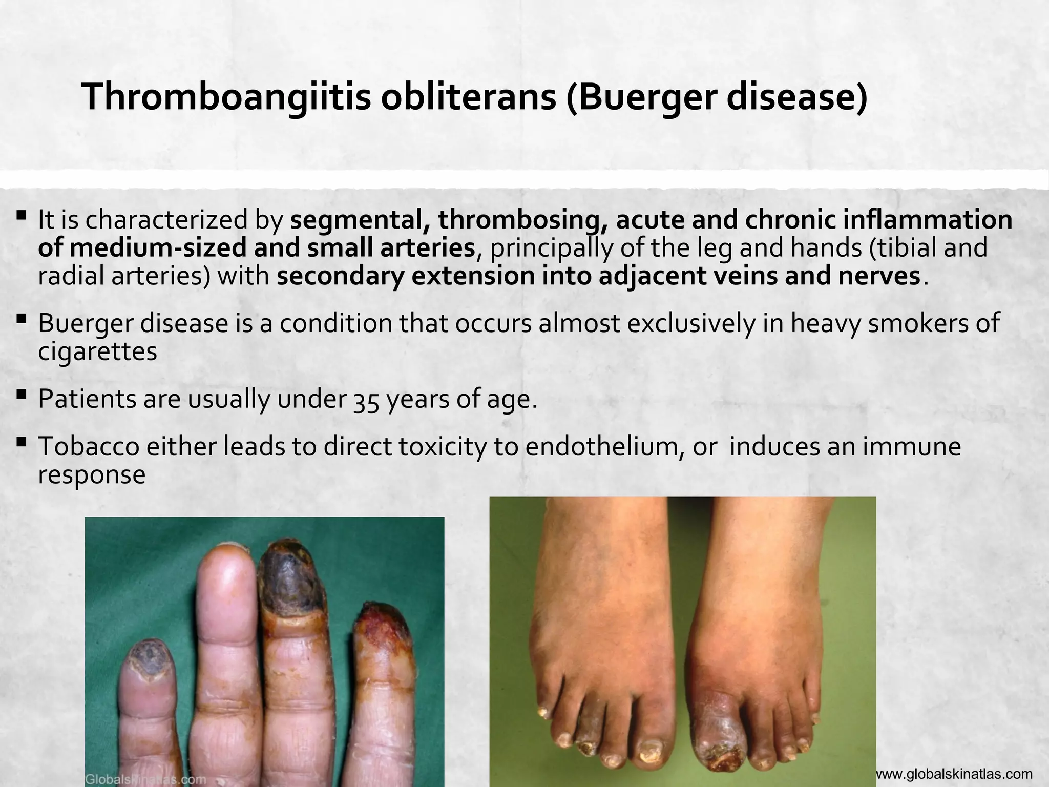 CVS Pathology 6 Vasculitis 2019 sufia husain | PPT