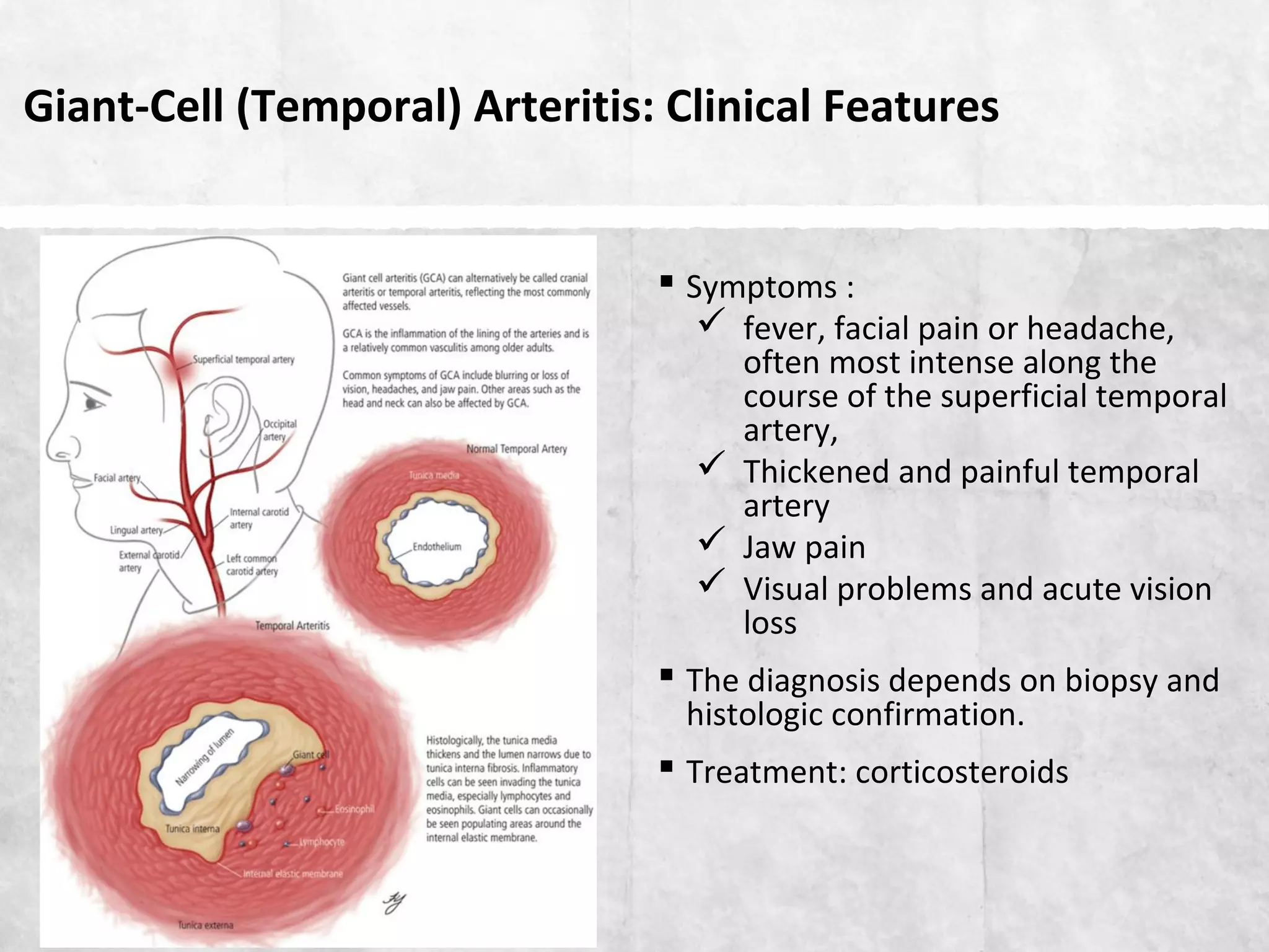 CVS Pathology 6 Vasculitis 2019 sufia husain | PPT