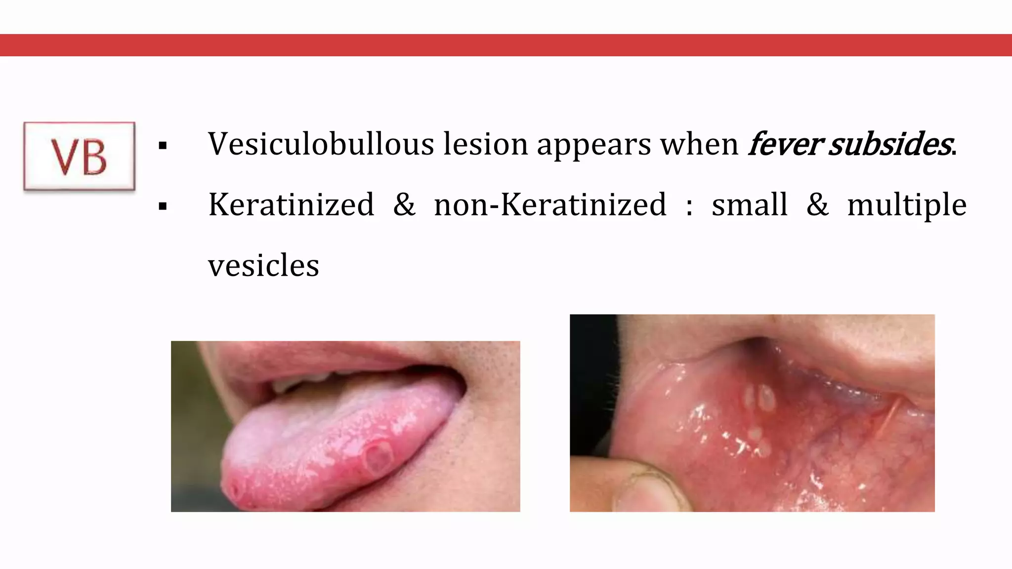 6 vb lesions (1) viral infection & hsv - copy | PPT