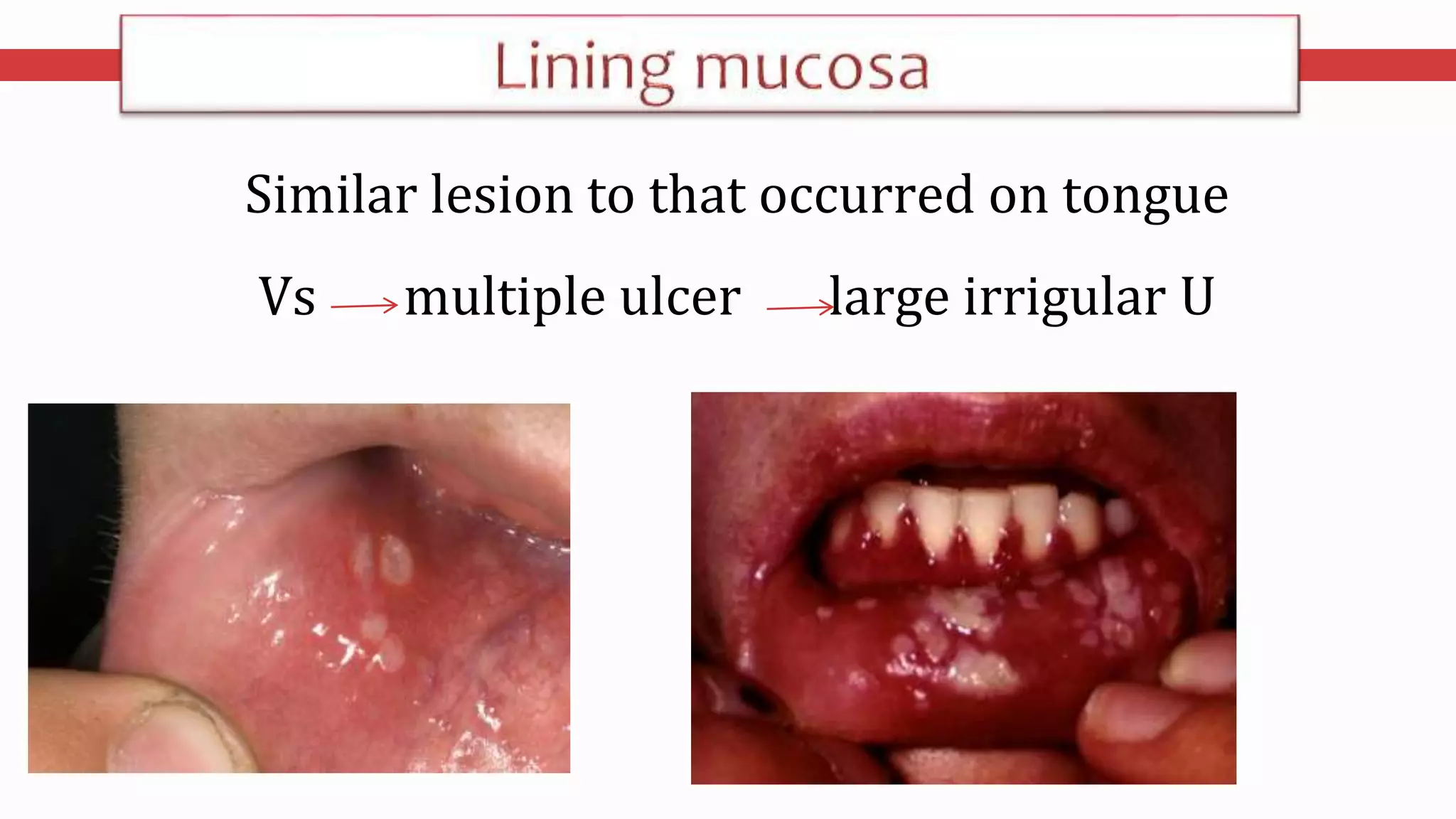 6 vb lesions (1) viral infection & hsv - copy | PPTX