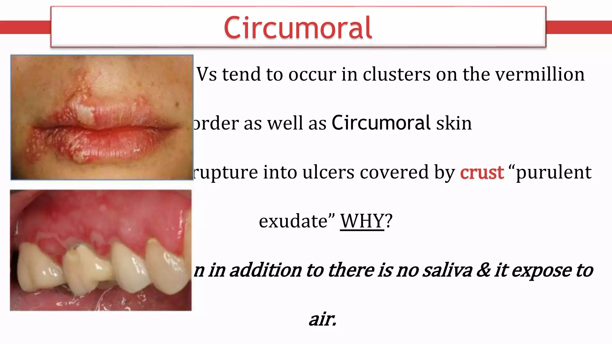 6 vb lesions (1) viral infection & hsv - copy | PPT