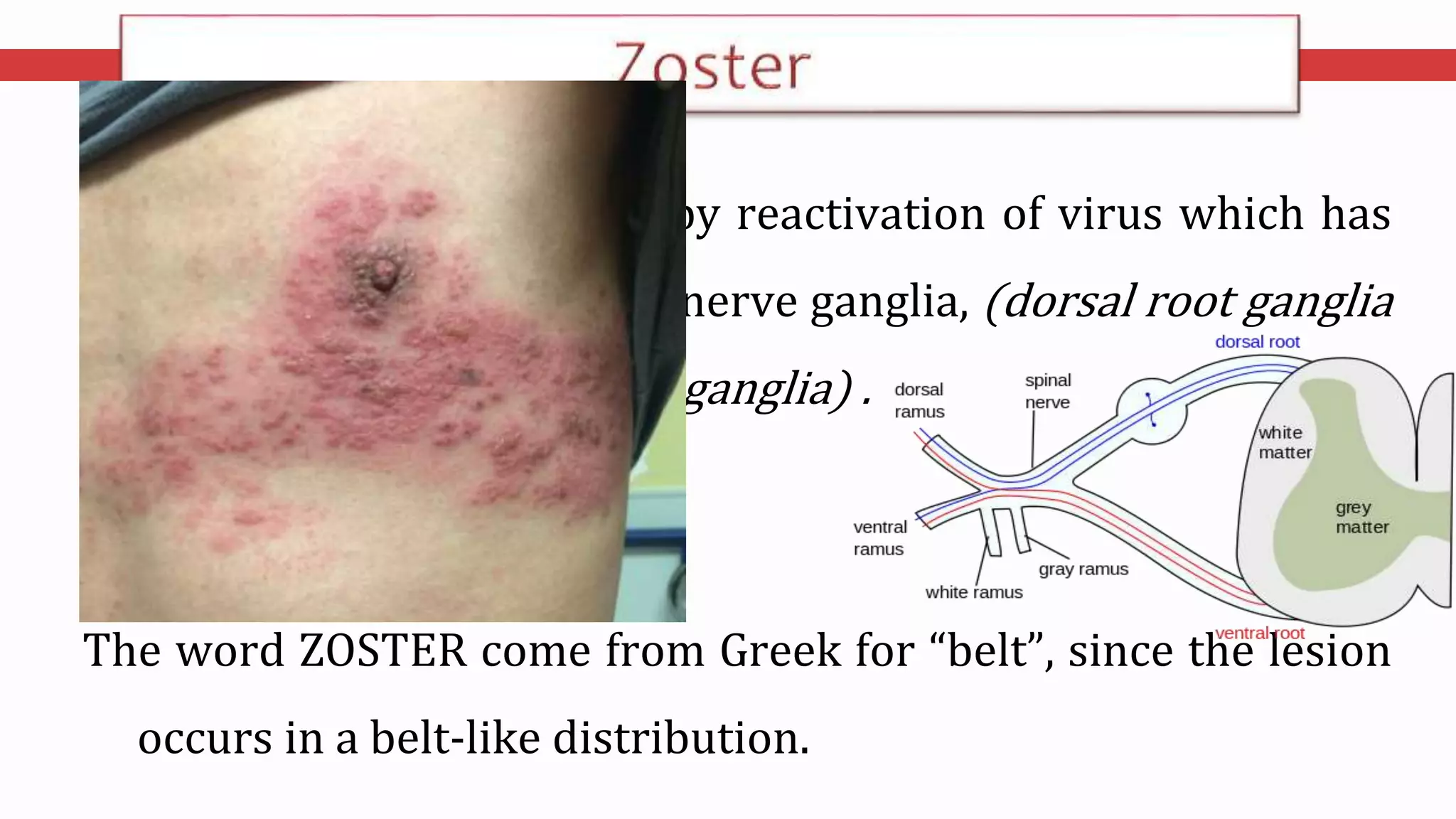 6 vb lesions (2) vzv + ramsy hunty s | PPTX